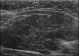 Hashimoto's thyroiditis - ΕΝΔΟΚΡΙΝΟΛΟΓΟΣ ΔΙΔΑΚΤΩΡ ΙΑΤΡΙΚΗΣ ΣΧΟΛΗΣ ...